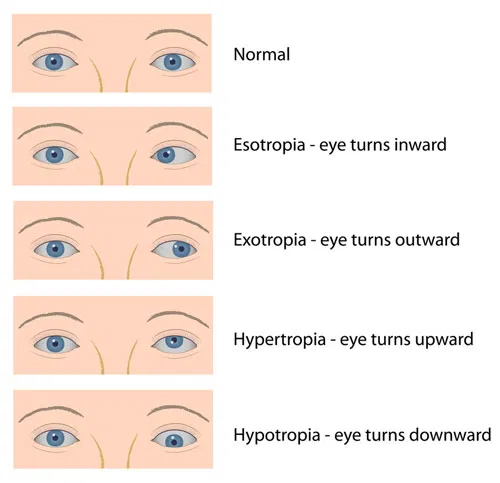 Understanding Squint in Eyes – Alpha Lead Academy