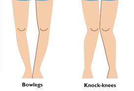 Understand about Knock Knee – Alpha Lead Academy